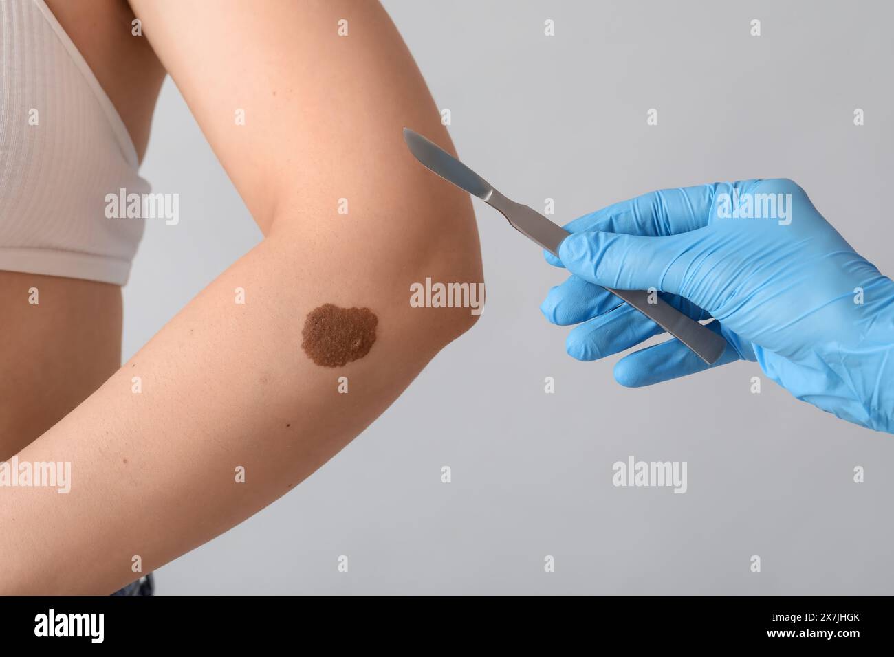 Surgeon with scalpel and birthmark on woman's arm against light ...