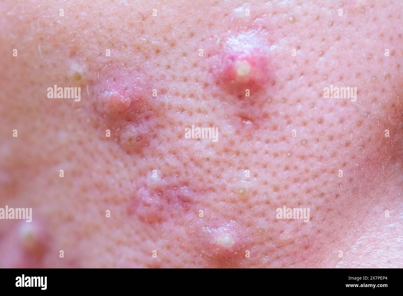 Caucasian female with cystic acne from clogged pores and oily skin Stock Photo - Alamy