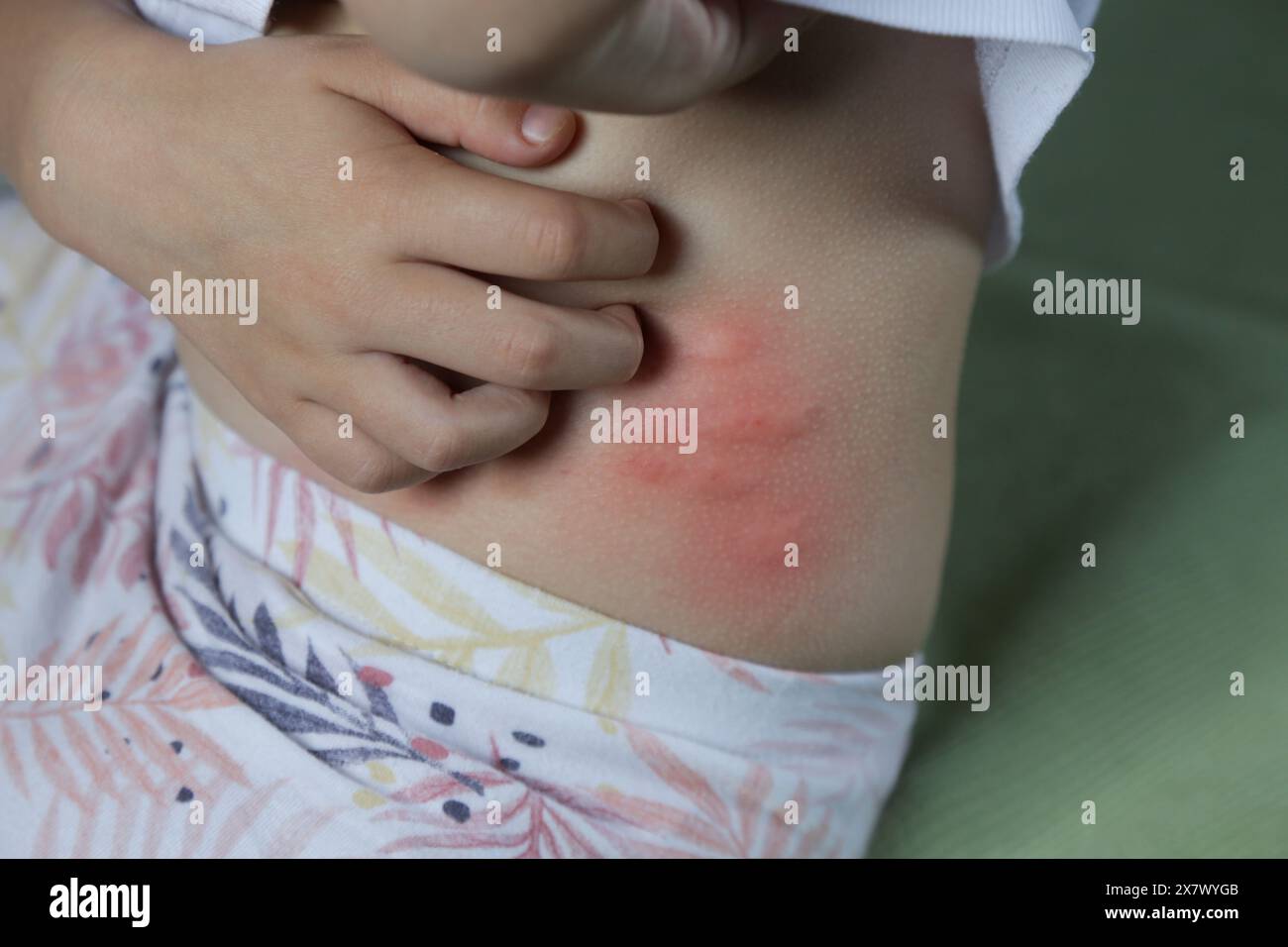 Red Swollen And Itchy Spots On Skin Caused By Insect Bites Or Allergy Skin Reaction To Insect