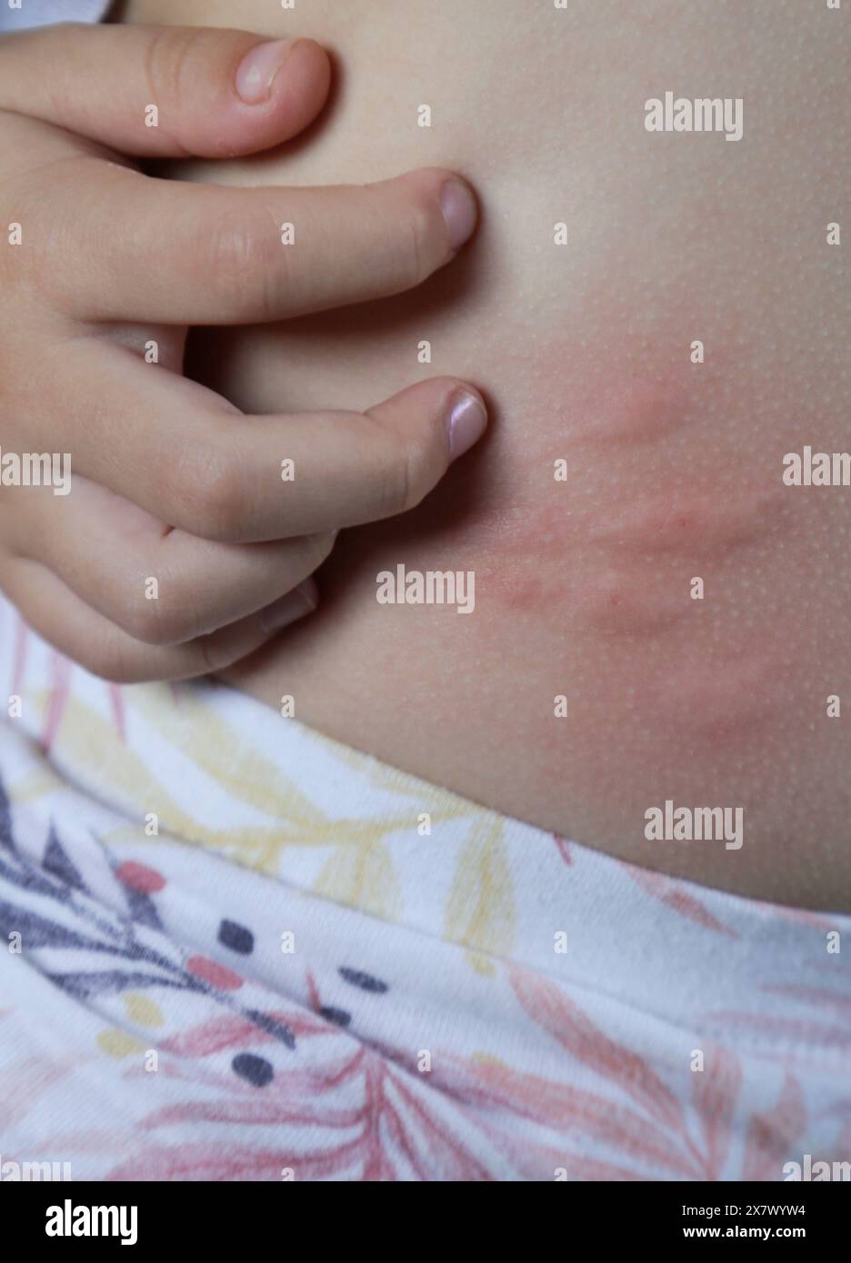 Red, swollen and itchy spots on skin caused by insect bites or allergy ...