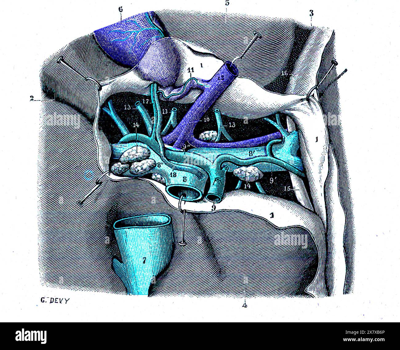 Illustration of the hilum of the liver (grey). A hilum is a fissure ...