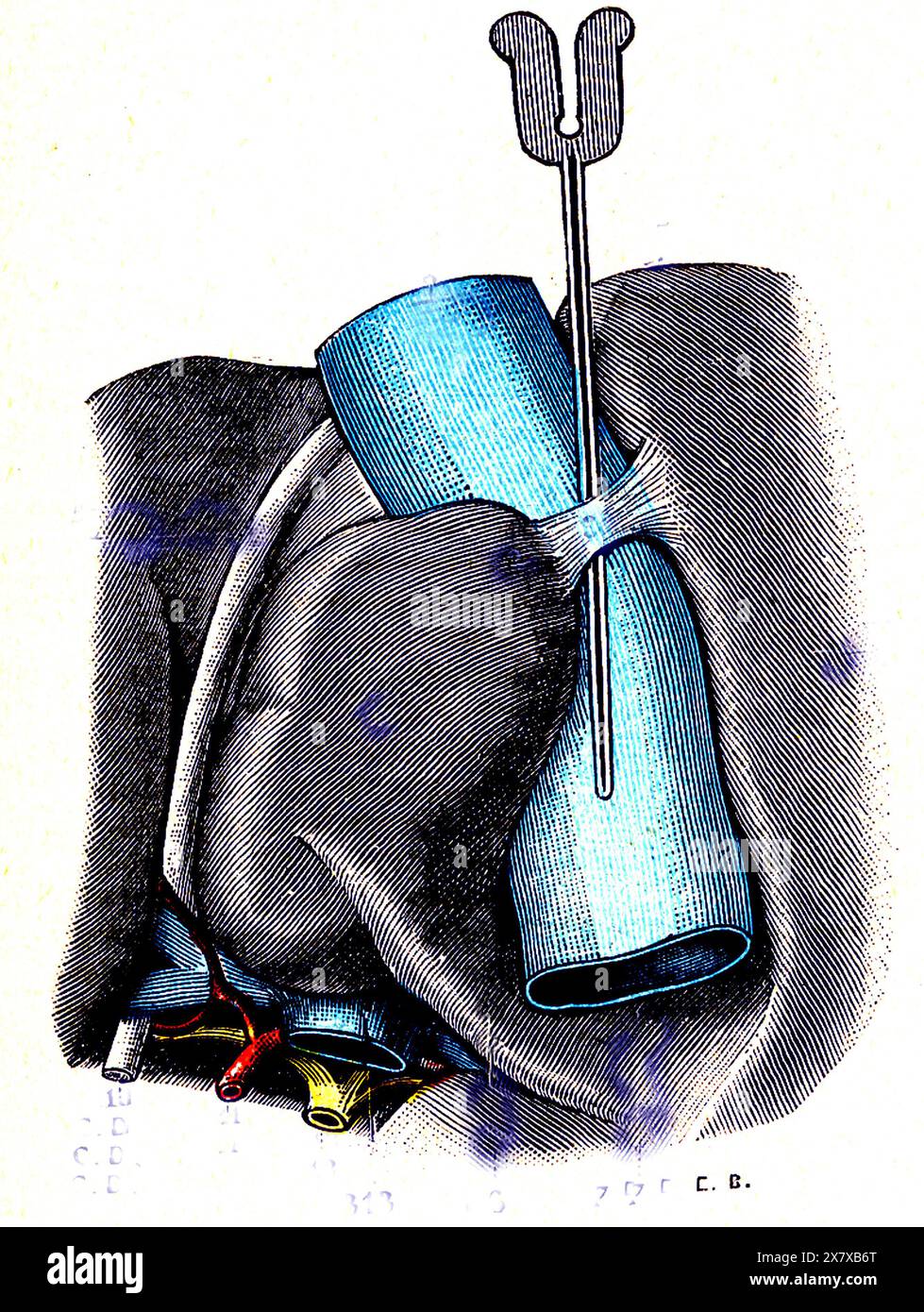Illustration of the inferior vena cava in the hepatic (liver) groove ...