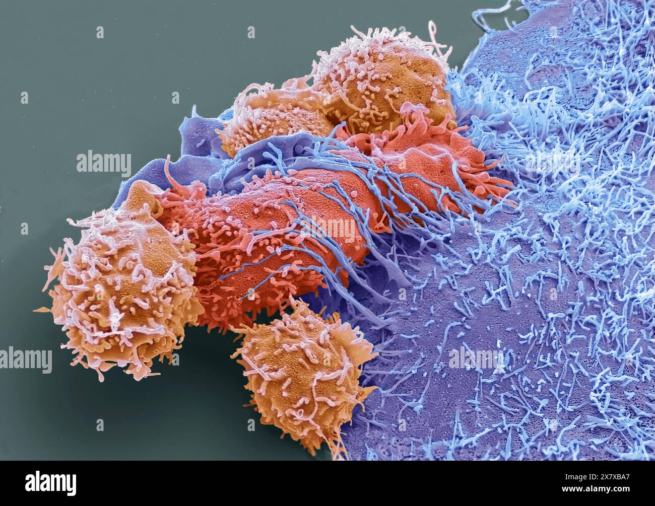 Hela cancer cell and T cells. Coloured scanning electron micrograph ...