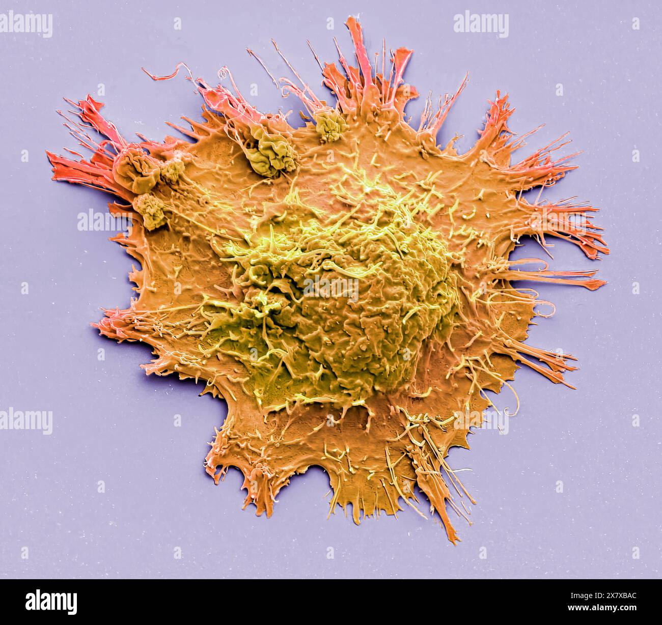 Brain cancer cell. Coloured scanning electron micrograph (SEM) of a ...