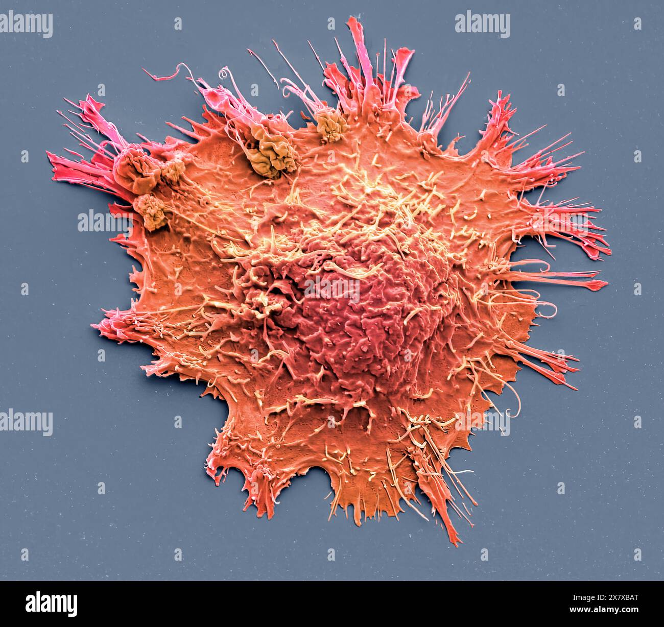 Brain cancer cell. Coloured scanning electron micrograph (SEM) of a ...