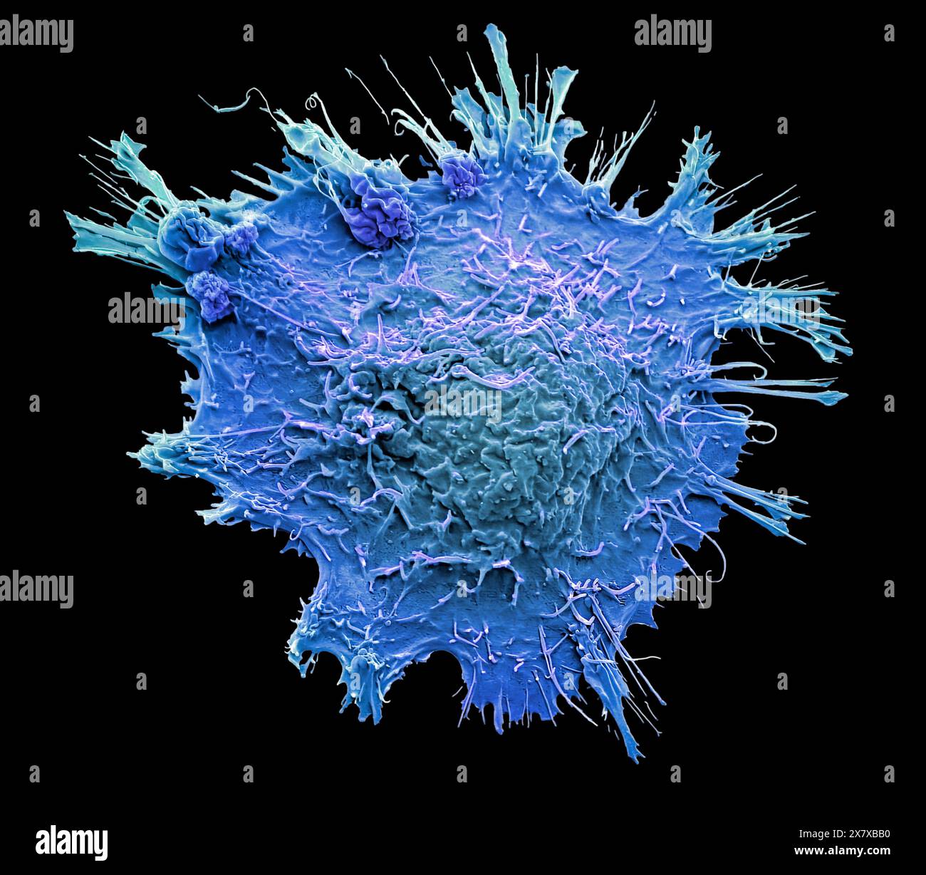 Brain cancer cell. Coloured scanning electron micrograph (SEM) of a ...
