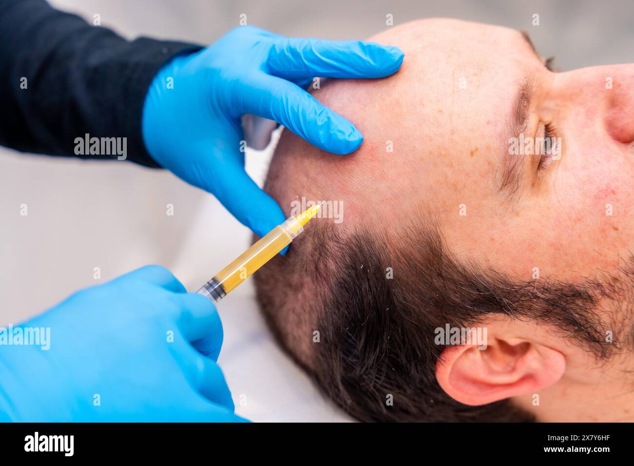 Dermatologist injecting centrifuged blood into the man's head to treat ...