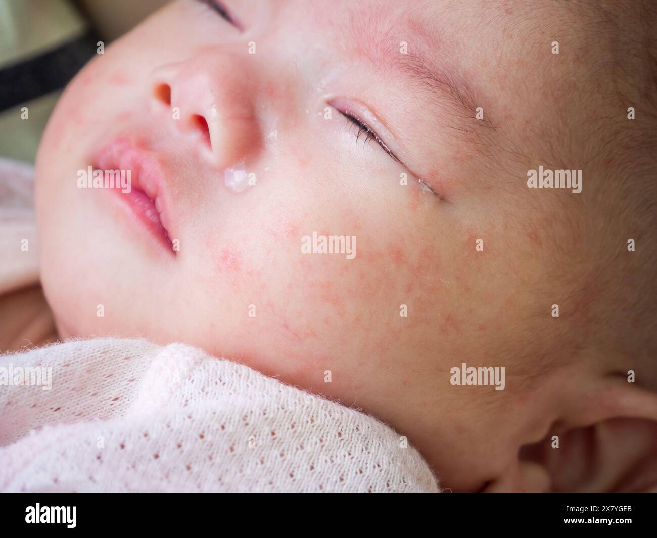 newborn baby with dermatitis allergy on face Stock Photo - Alamy