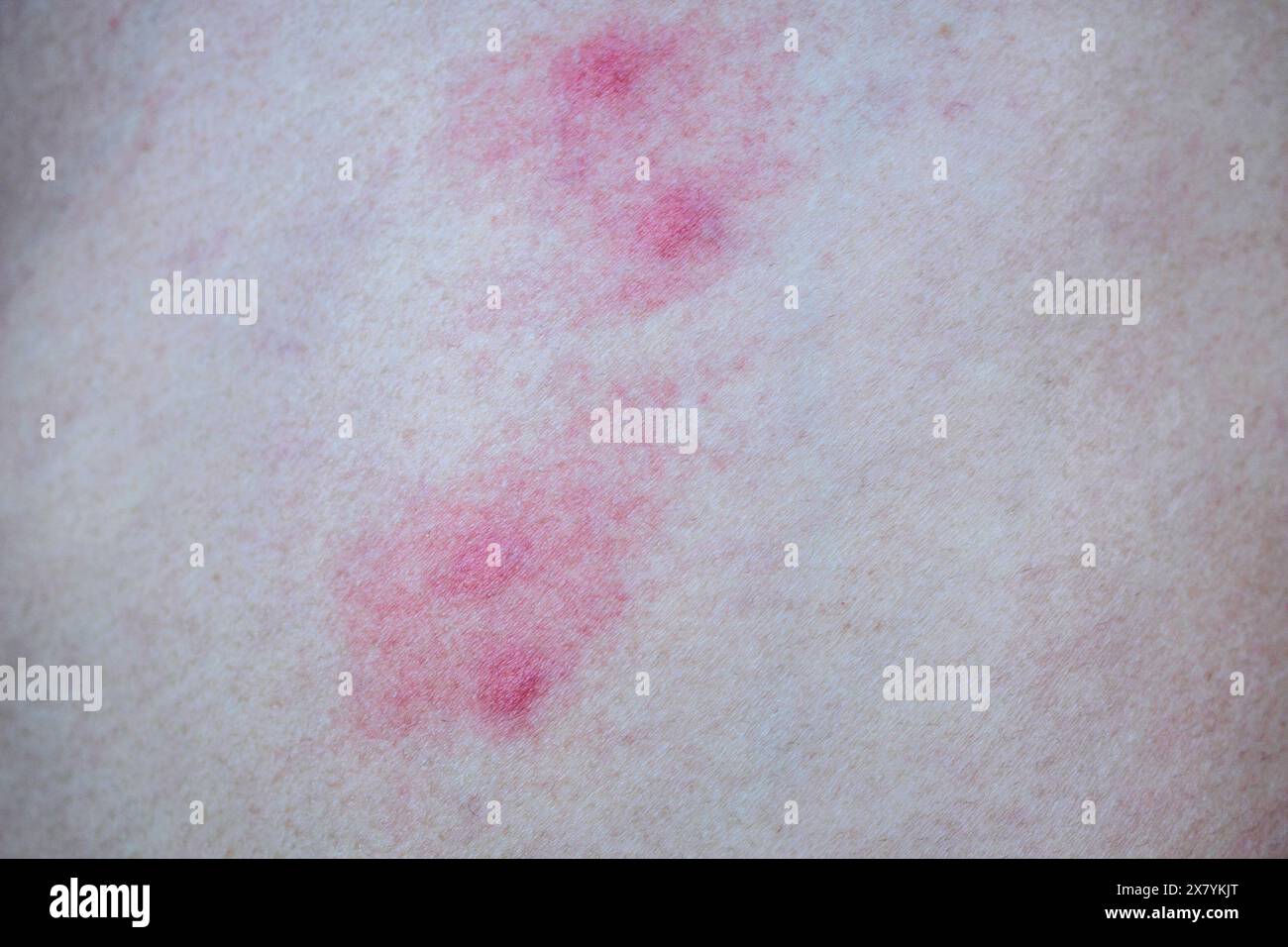 Skin allergy from mosquito bites Stock Photo - Alamy