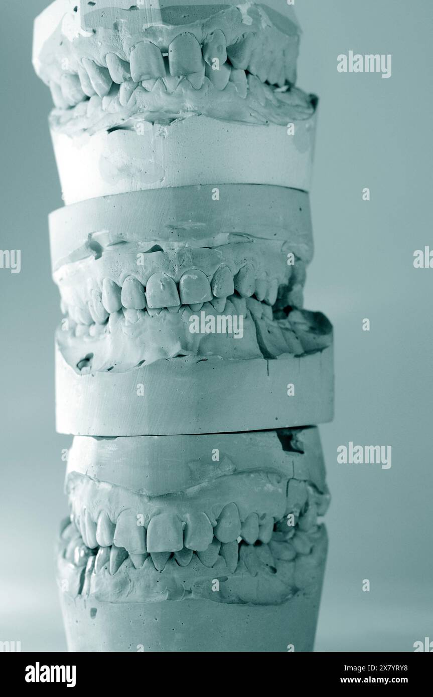 Impression Mold of Teeth Stock Photo - Alamy