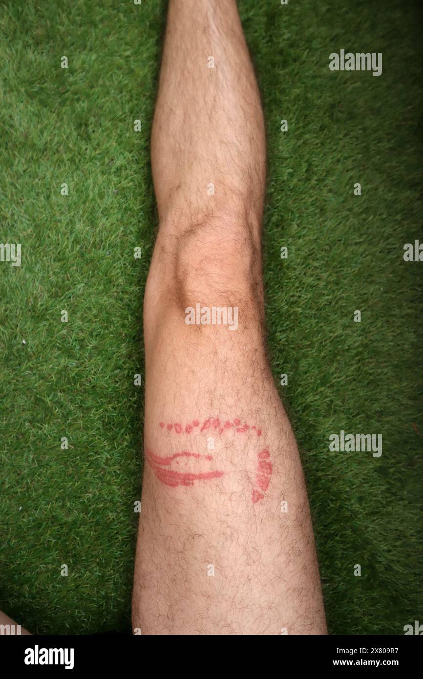 Sting burn hi-res stock photography and images - Alamy