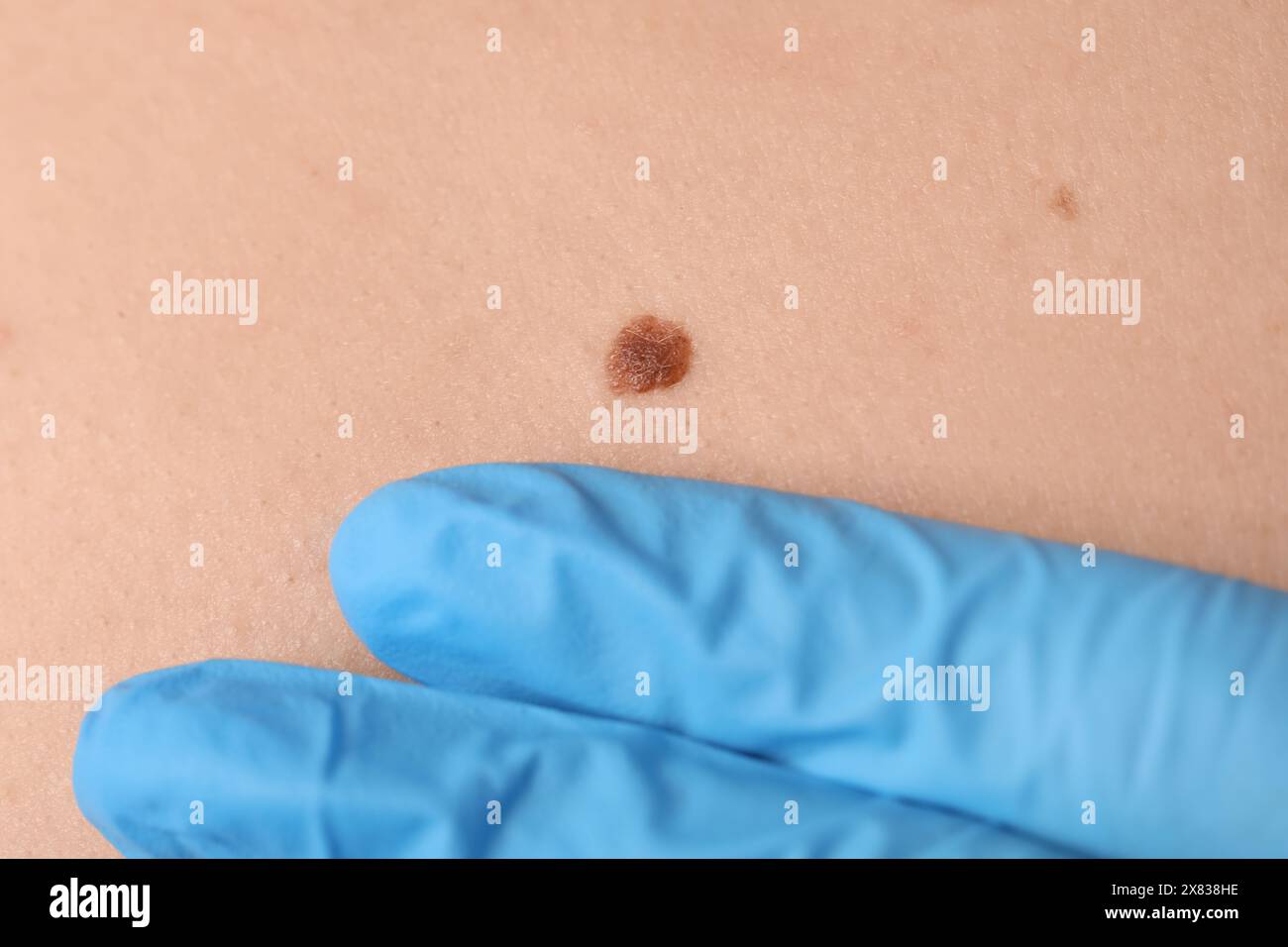 Dermatologist examining mole on woman's body, closeup Stock Photo - Alamy