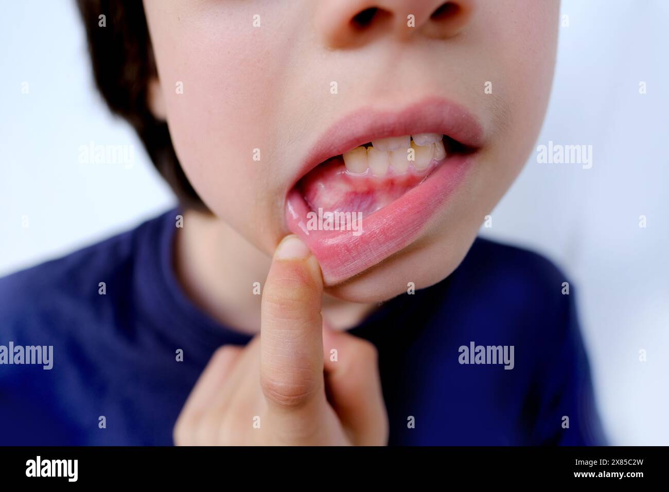 closeup part of boy of 10 years old opened his mouth, oral cavity ...