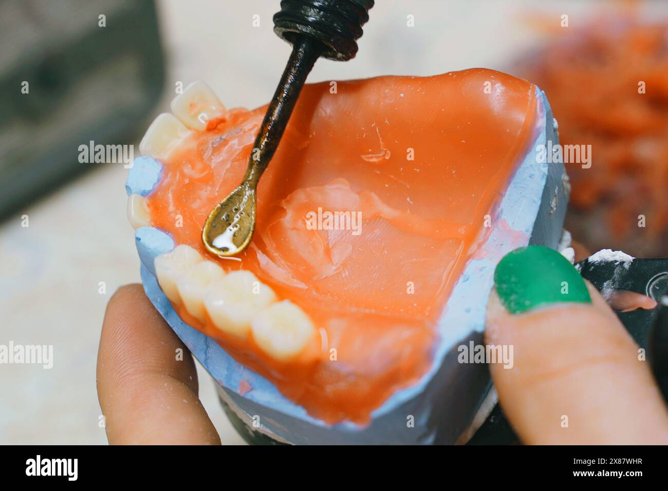 The dental technician makes a wax base and adds wax to form the mold ...