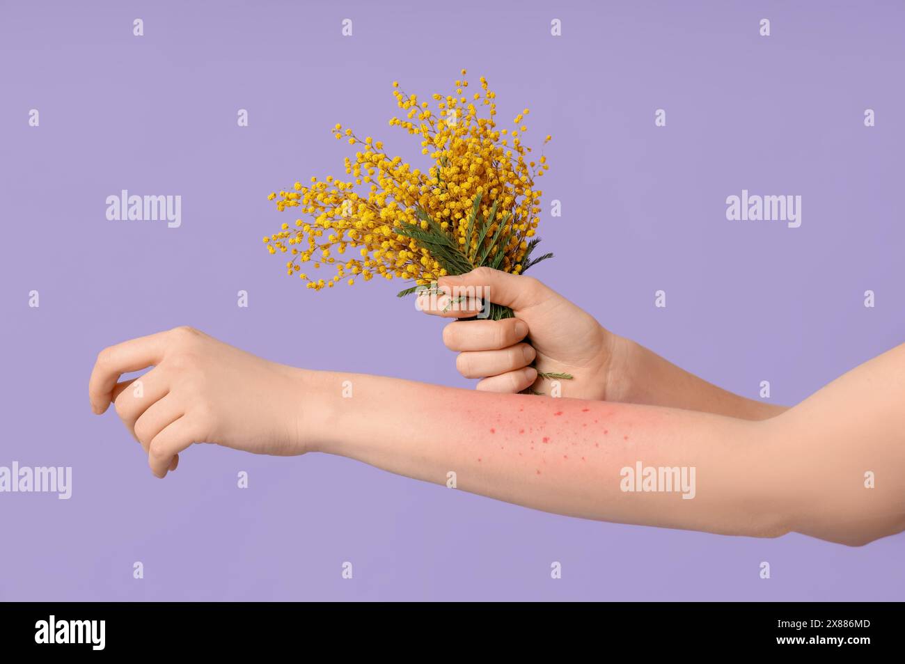 Young woman with skin allergy and mimosa on purple background Stock ...