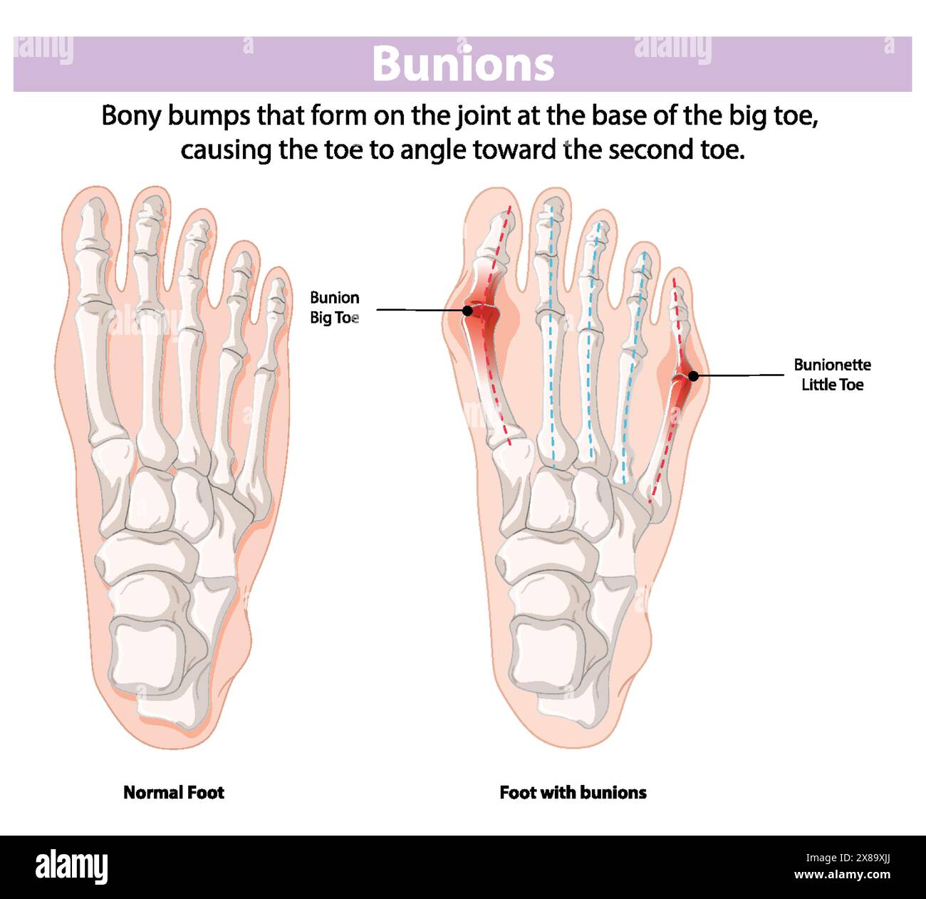 Illustration of normal foot and foot with bunions Stock Vector Image ...