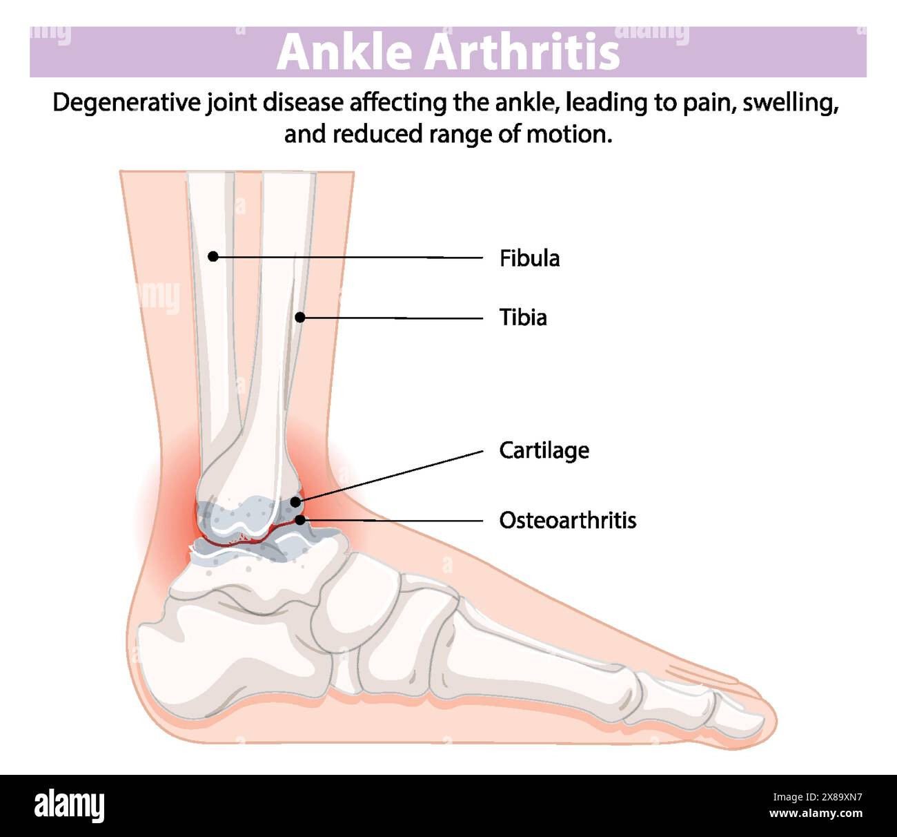 Diagram showing ankle arthritis and affected areas Stock Vector Image ...