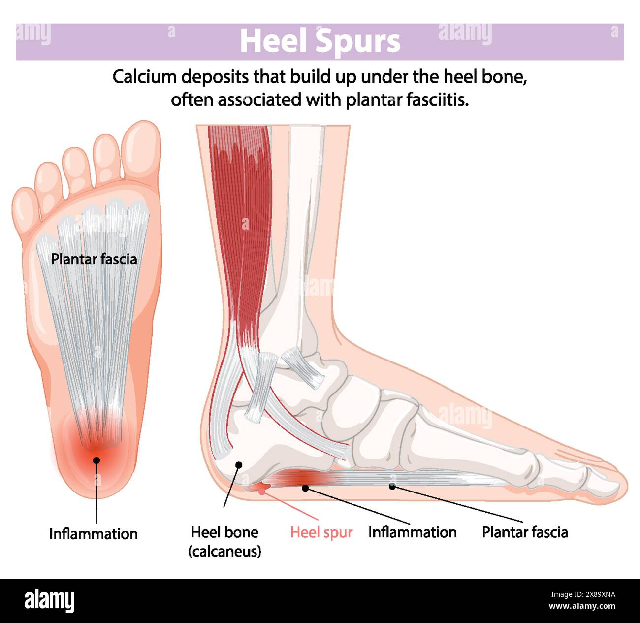Plantar fascia diagram hi-res stock photography and images - Alamy