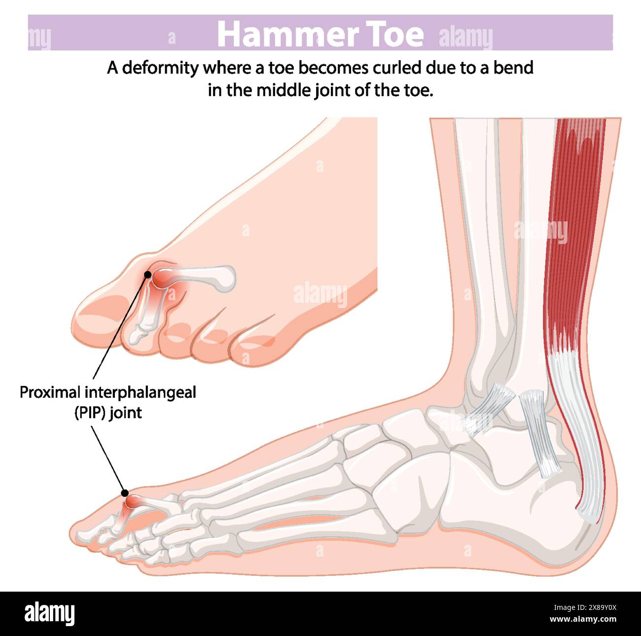 Diagram showing hammer toe deformity and PIP joint Stock Vector Image ...