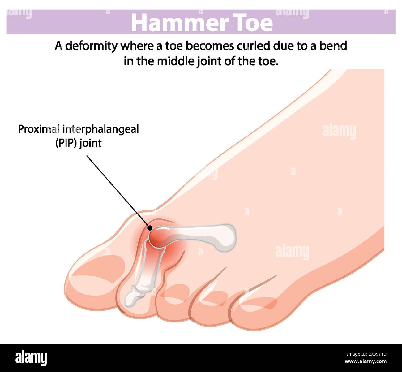 Interphalangeal Joint Toe Toe Joint Deformities