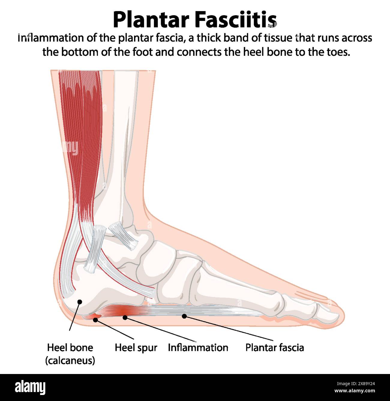 Plantar fascia diagram hi-res stock photography and images - Alamy