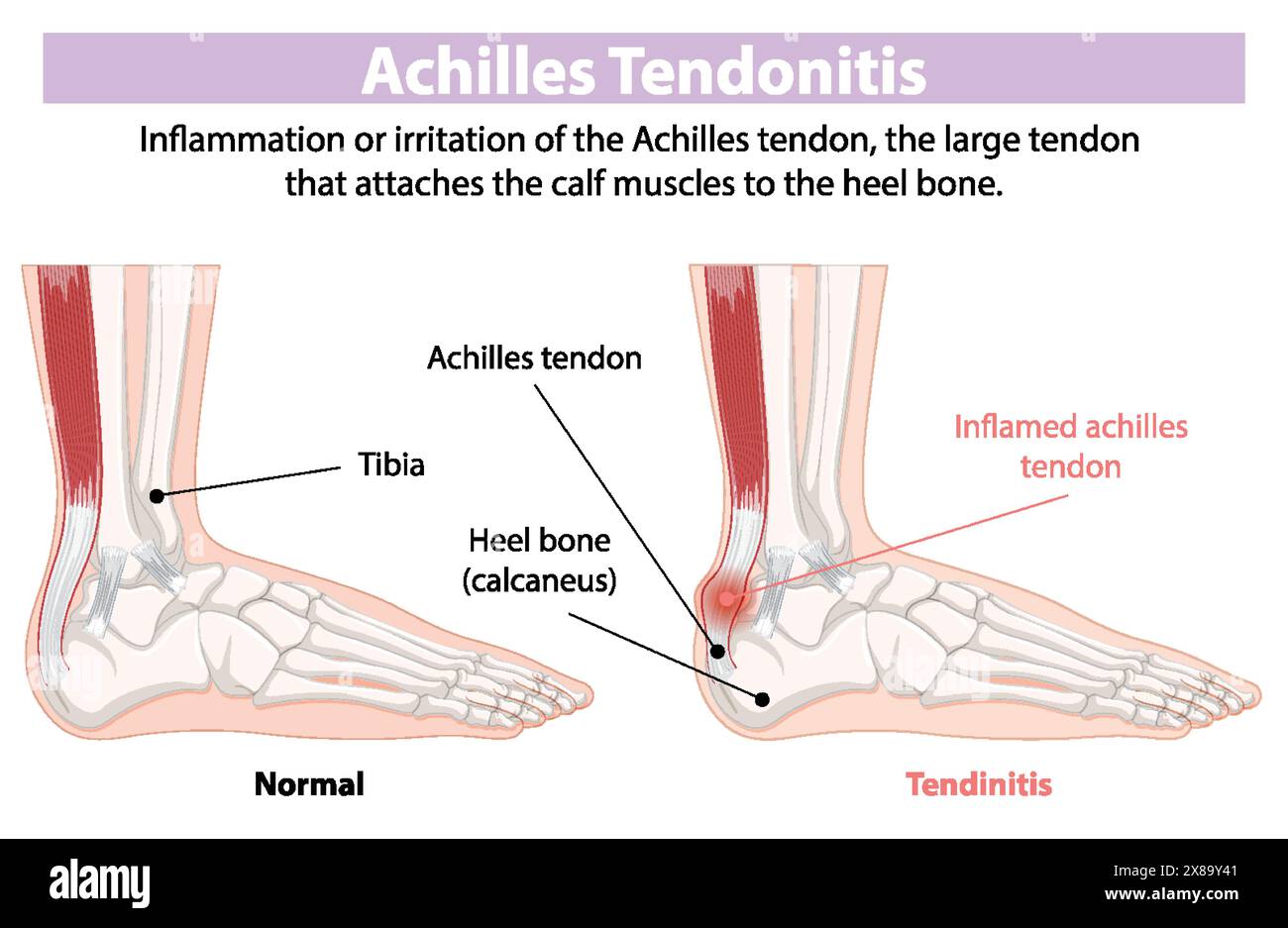 Comparison Of Normal And Inflamed Achilles Tendon Stock Vector Image And Art Alamy
