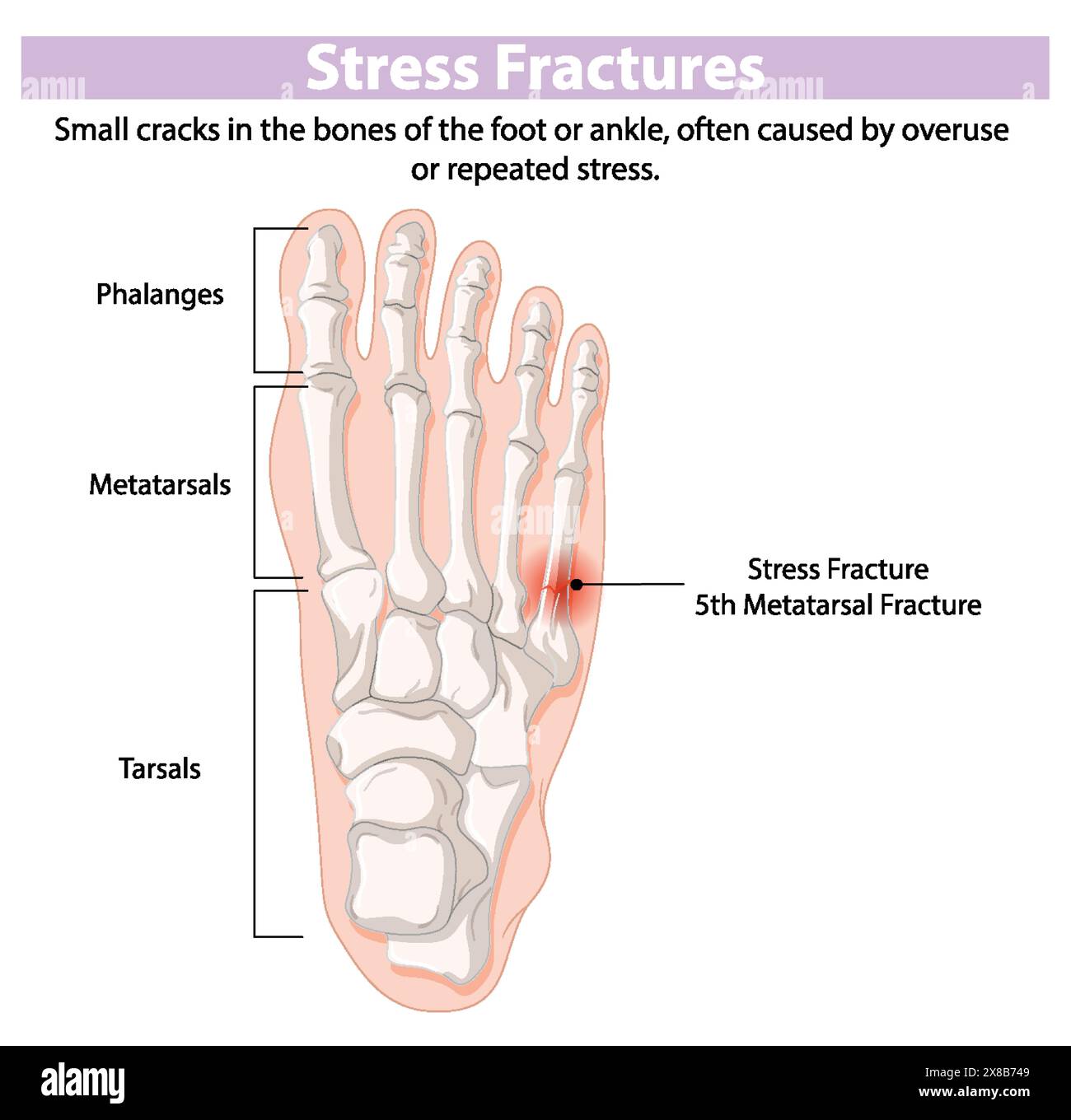 Diagram showing stress fractures in foot bones Stock Vector Image & Art ...