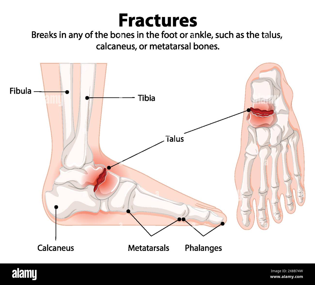 Illustration Of Foot And Ankle Bone Fractures Stock Vector Image And Art