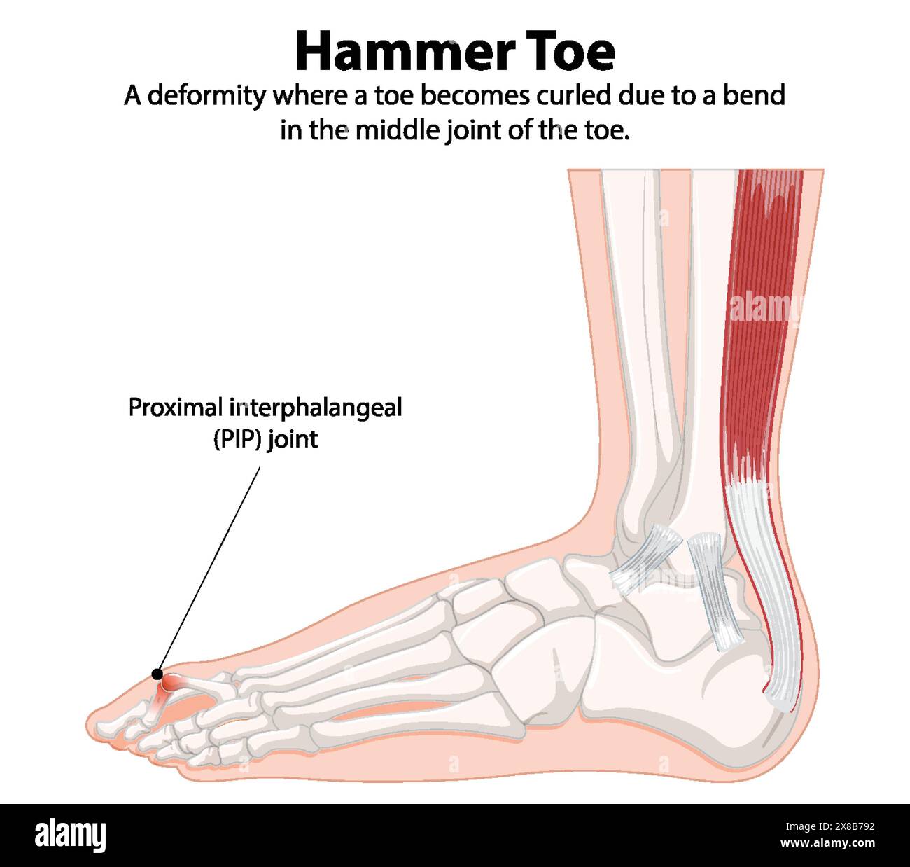 Diagram showing hammer toe deformity and PIP joint Stock Vector Image ...