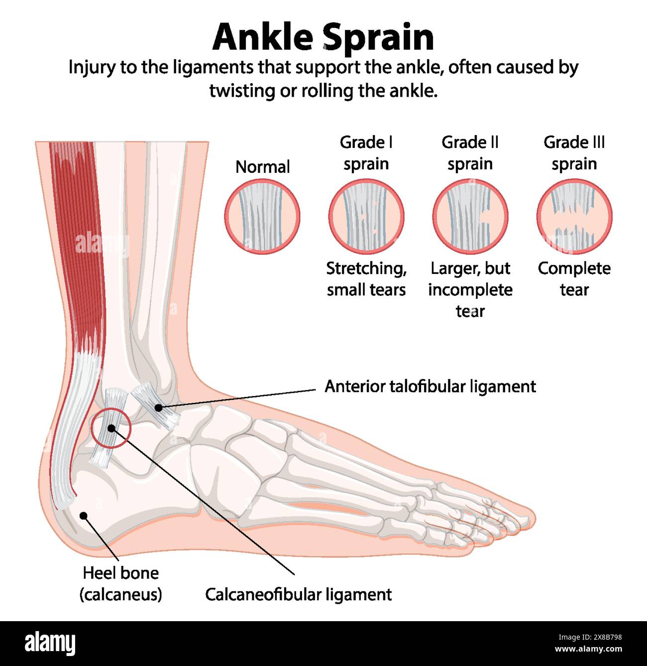 Detailed diagram of ankle sprain types Stock Vector Image & Art - Alamy