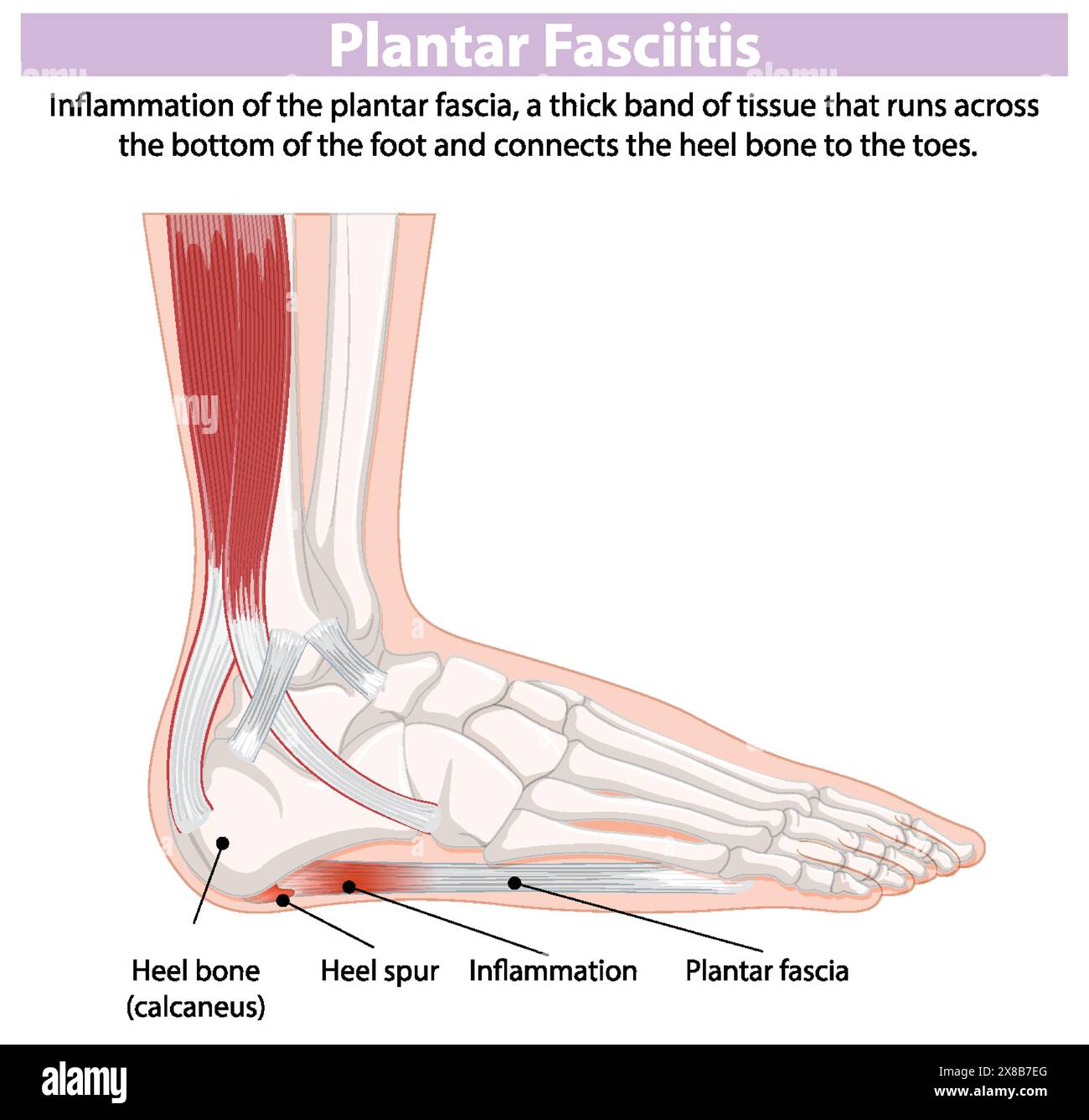Plantar fascia diagram hi-res stock photography and images - Alamy