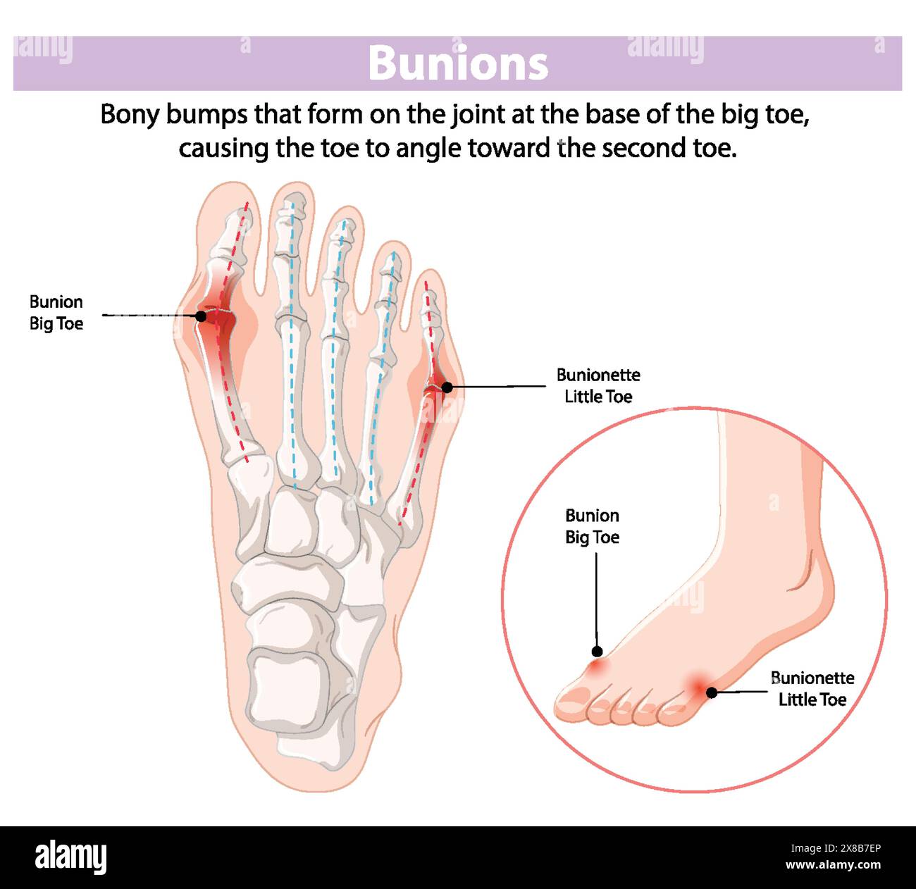 Illustration of bunions on big and little toes Stock Vector Image & Art ...