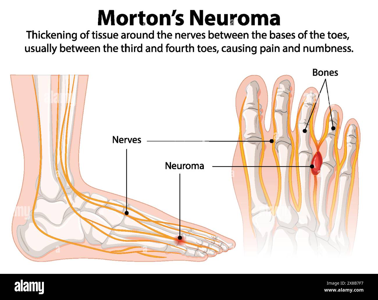 Foot nerves diagram hi-res stock photography and images - Alamy