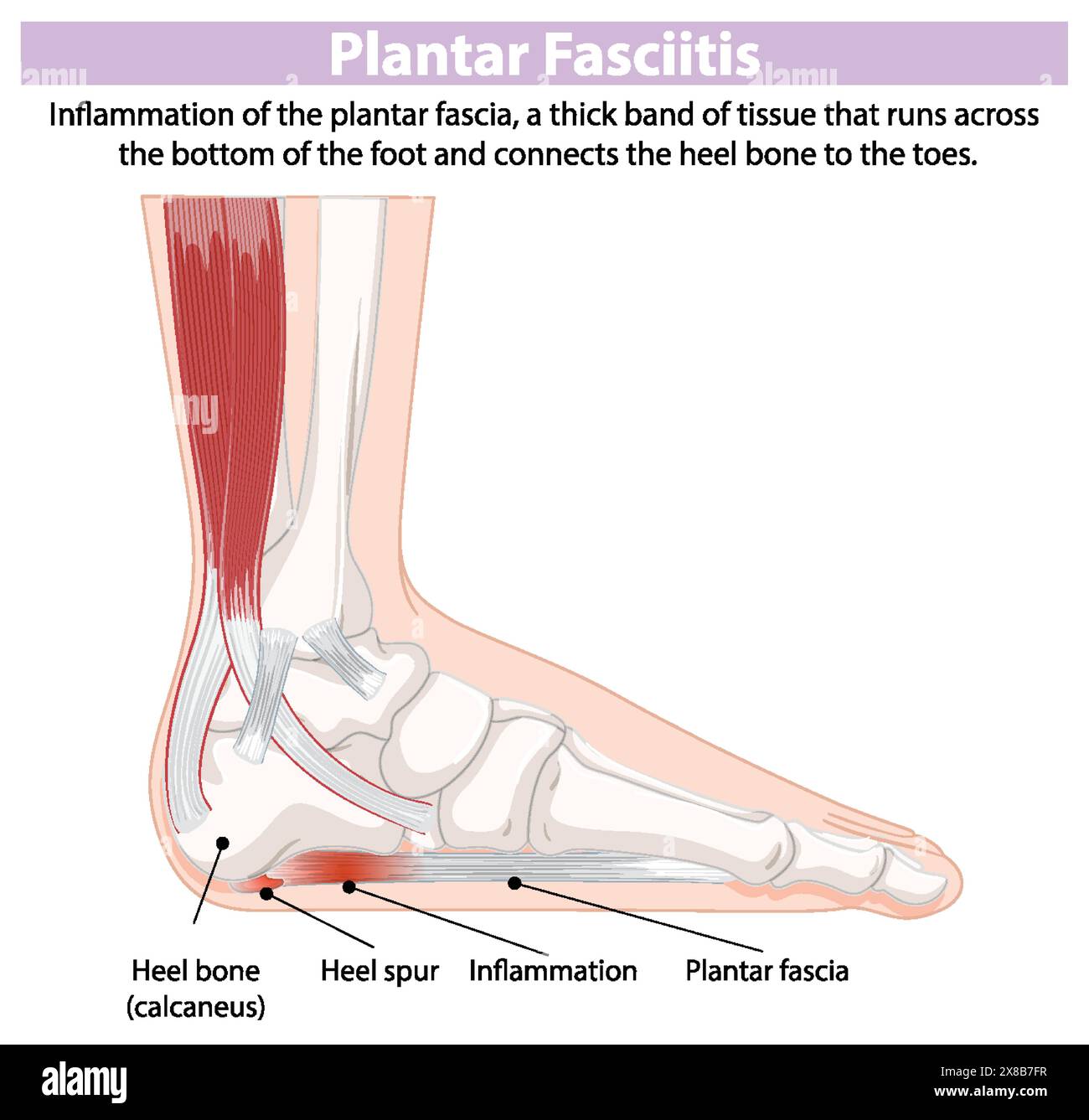 Detailed diagram of foot inflammation Stock Vector Image & Art - Alamy