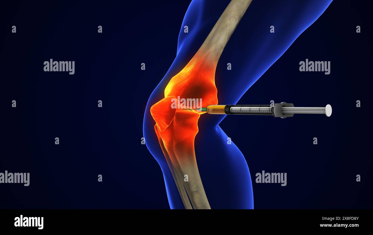 Anatomy Human Knee Joint Treatment, Osteoarthritis Injection Stock Photo - Alamy