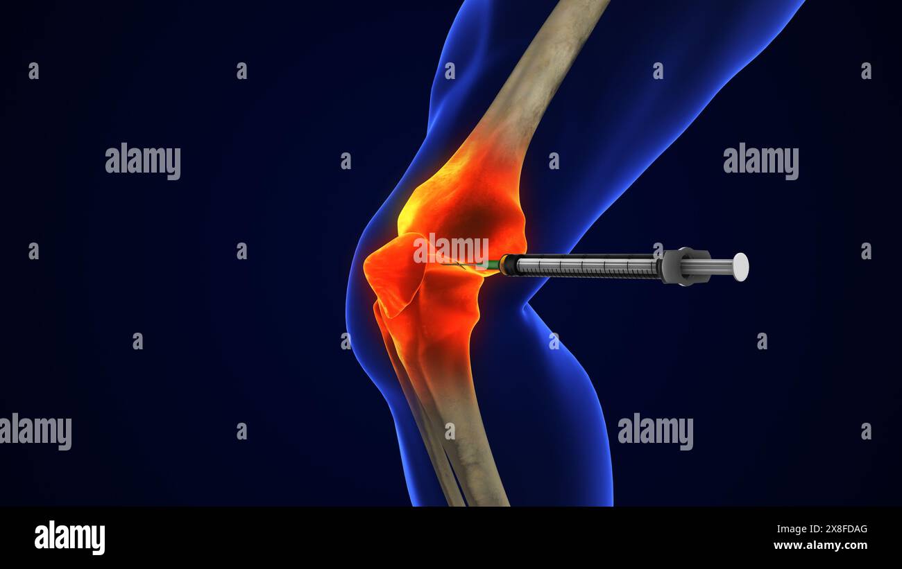 Anatomy Human Knee Joint Treatment, Osteoarthritis Injection Stock ...