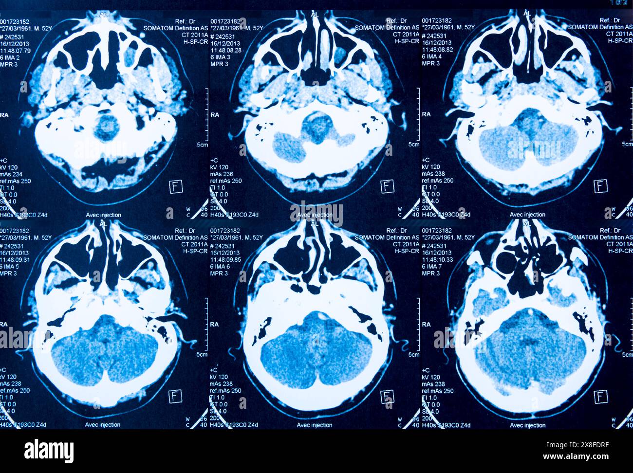 Tomography of the brain obtained by scanner. Brain scan 013843 019 ...