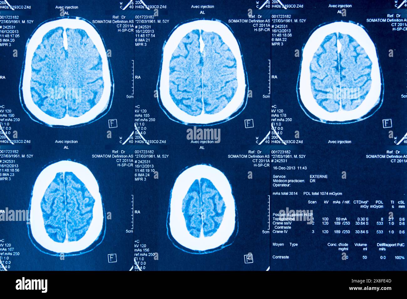 Tomography of the brain obtained by scanner. Brain scan 013843 023 ...