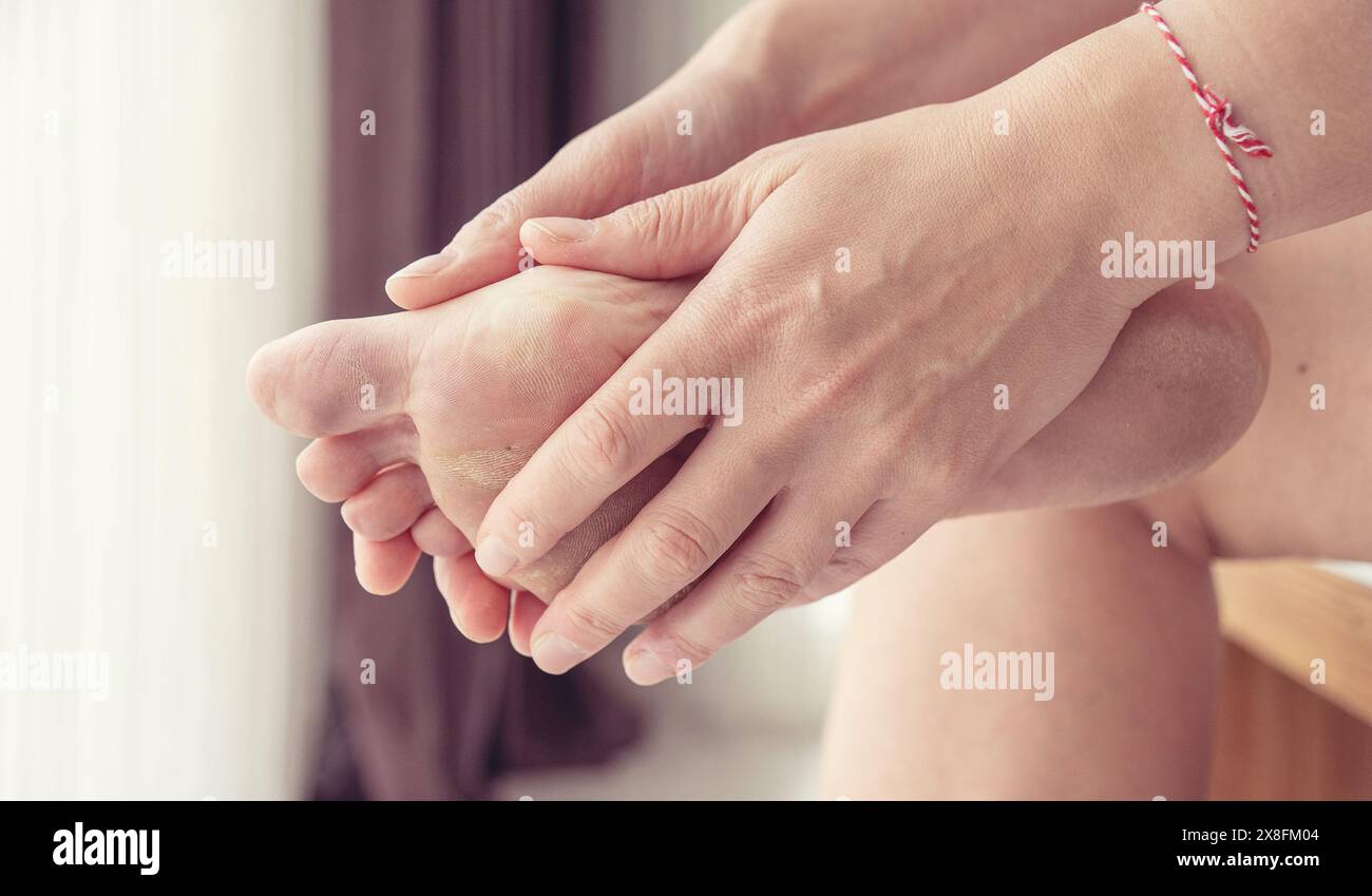 dirty and neglected feet, care and pedicure required Stock Photo - Alamy