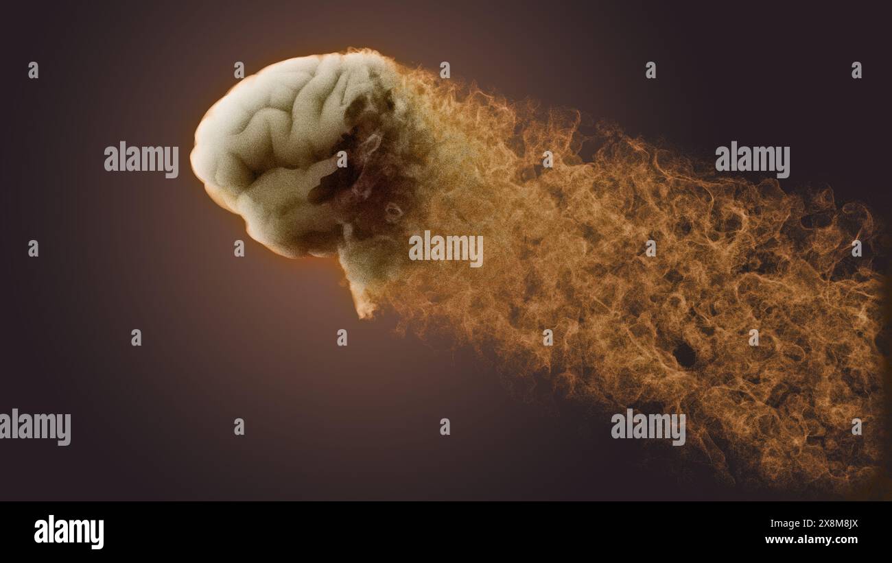 Brain seen from the side. Degenerative disease. Brain degenerative ...