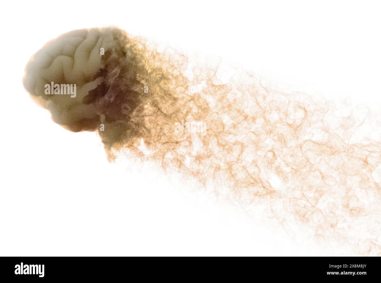 Brain seen from the side. Degenerative disease. Brain degenerative ...