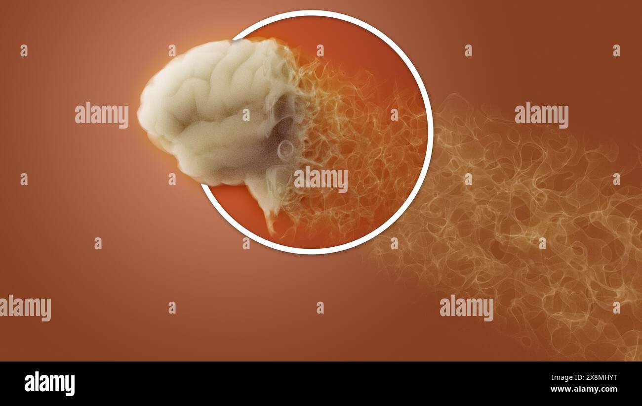 Brain seen from the side. Degenerative disease. Brain degenerative ...