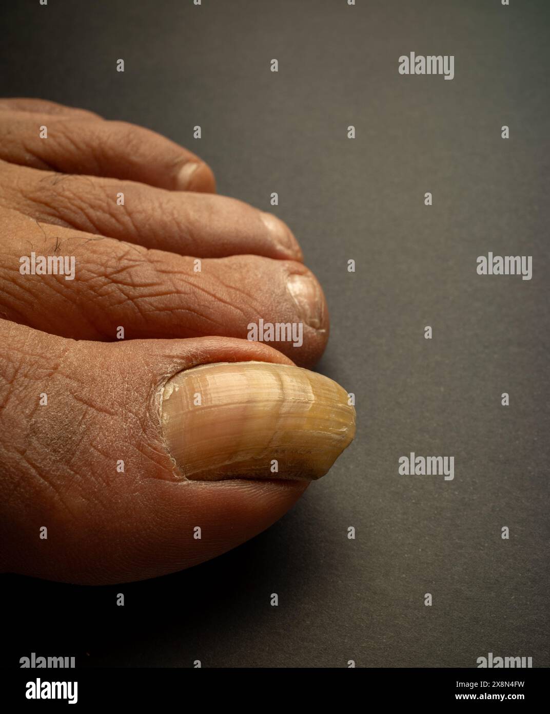 Longitudinal onychomycosis hi-res stock photography and images - Alamy
