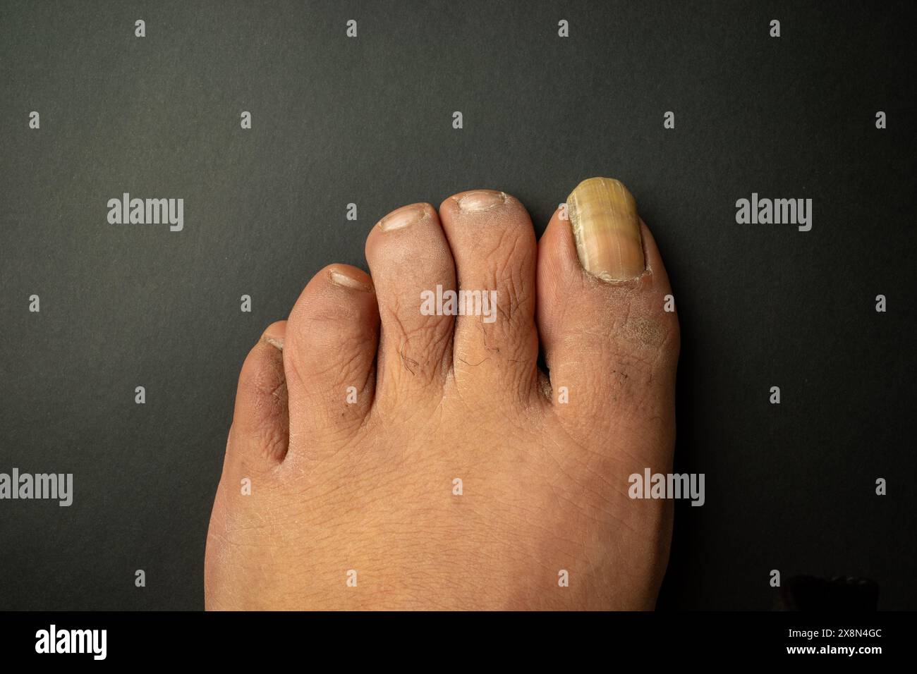 Hypertrophic onychopathy hi-res stock photography and images - Alamy