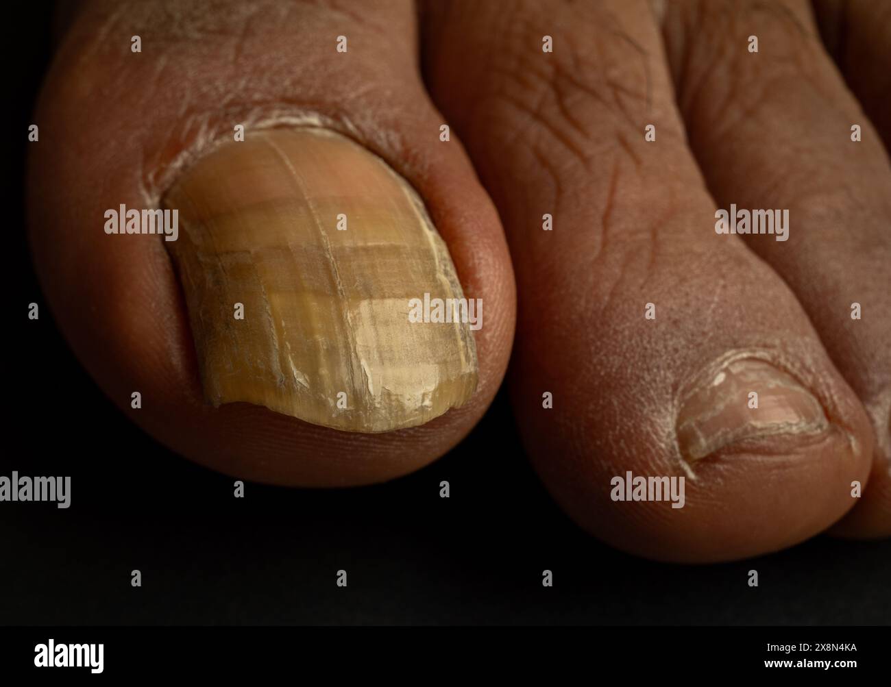 photo of foot with long thumb toe nail Stock Photo - Alamy