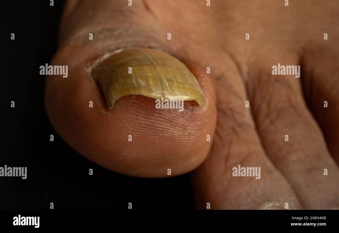 Longitudinal onychomycosis hi-res stock photography and images - Alamy