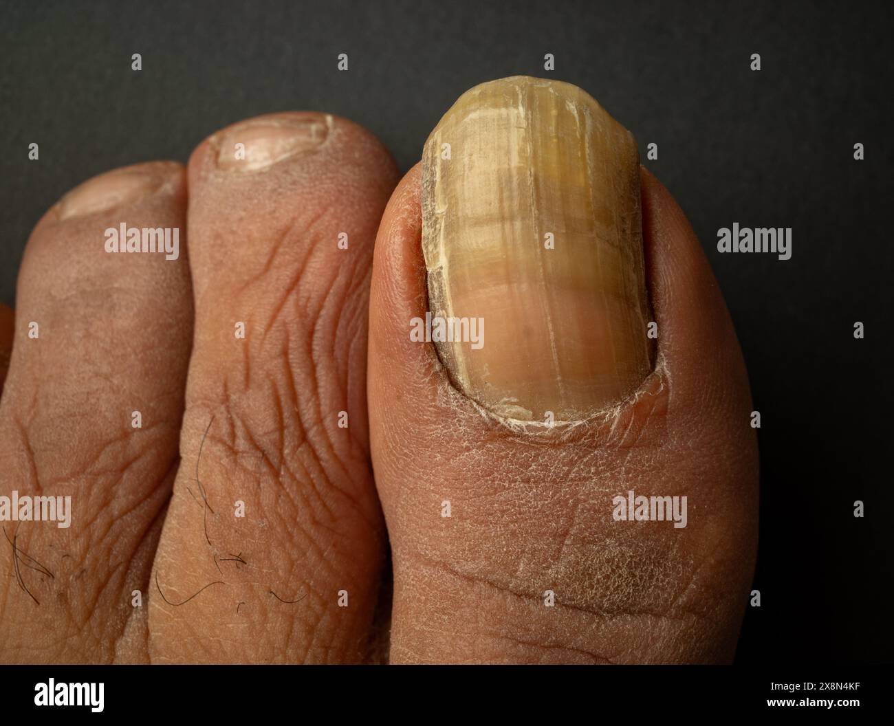 Longitudinal onychomycosis hi-res stock photography and images - Alamy
