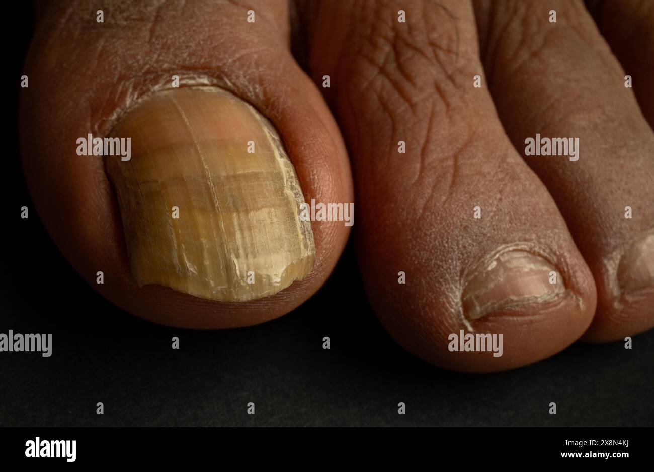 photo of foot with long thumb toe nail Stock Photo - Alamy