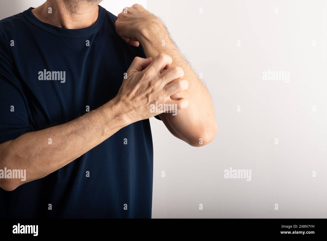 Middle-aged man scratching his forearm. Skin disease. Dermatological ...