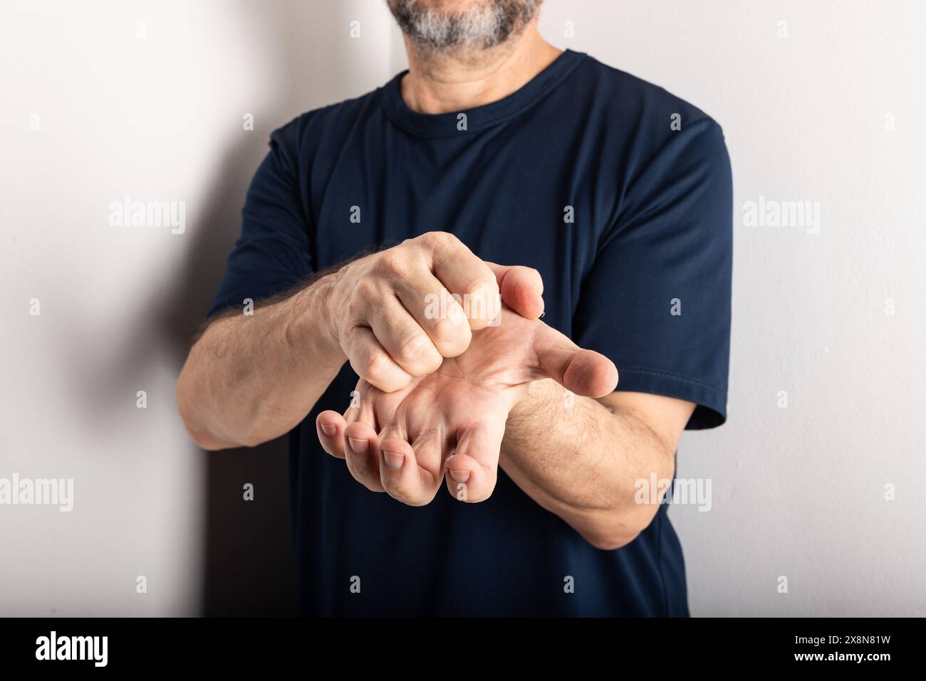 Middle aged man scratching his hand. Skin disease. Allergic reaction ...